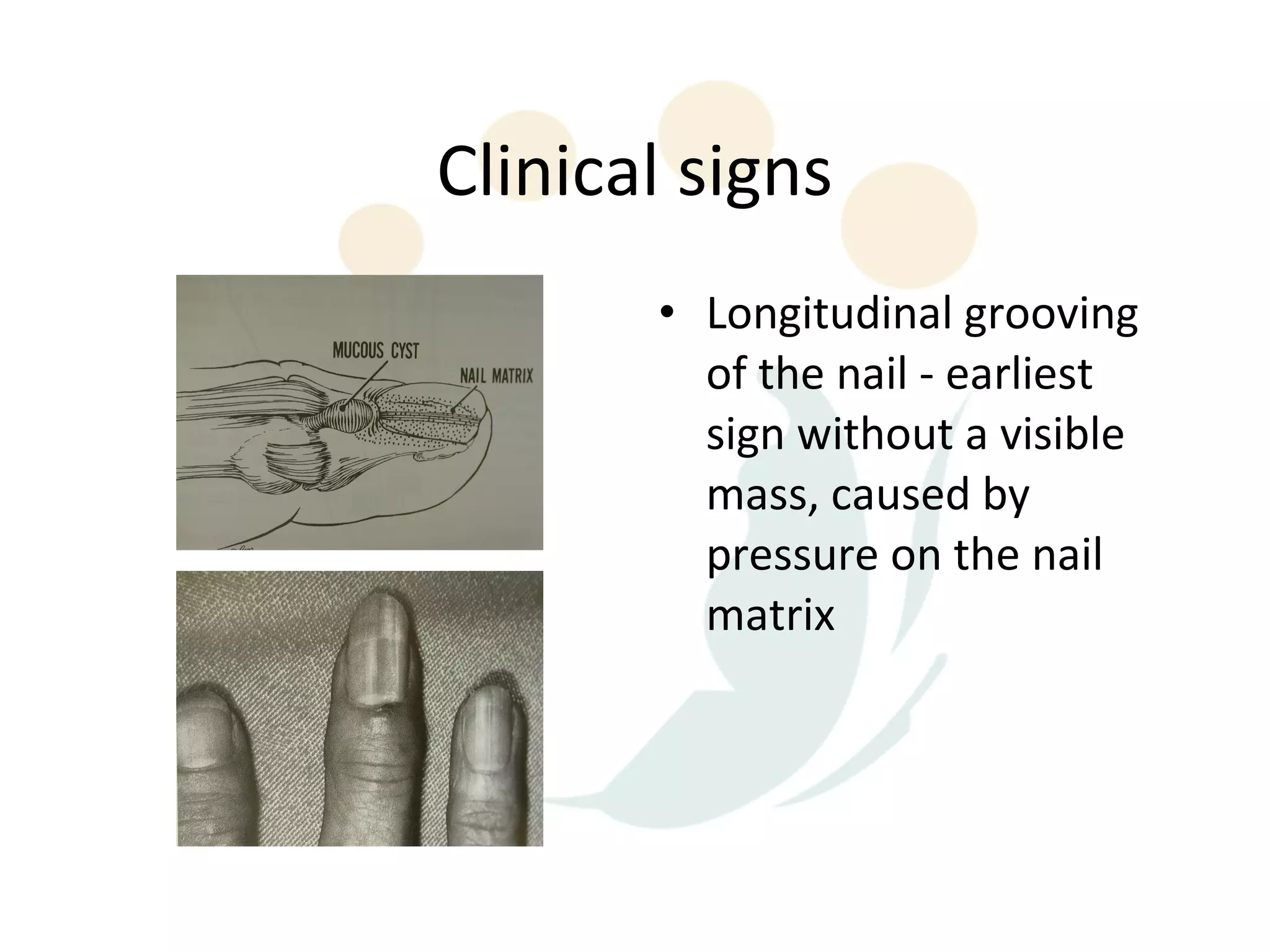 Mucous cysts dip jw | PPT
