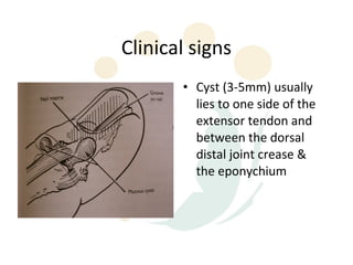 Mucous cysts dip jw | PPT