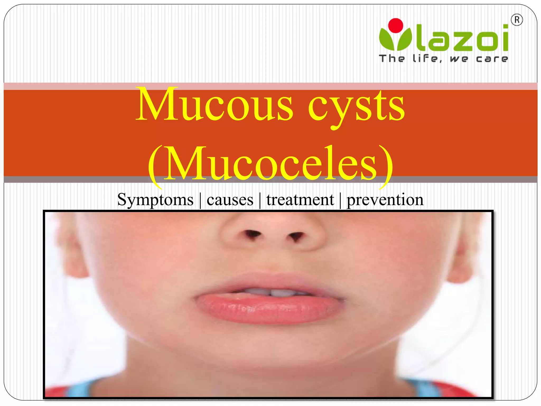 Mucous cysts (Mucoceles): Symptoms, causes, treatment and preventions ...