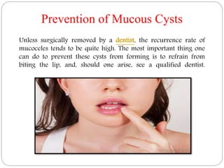 Mucous cysts (Mucoceles): Symptoms, causes, treatment and preventions ...