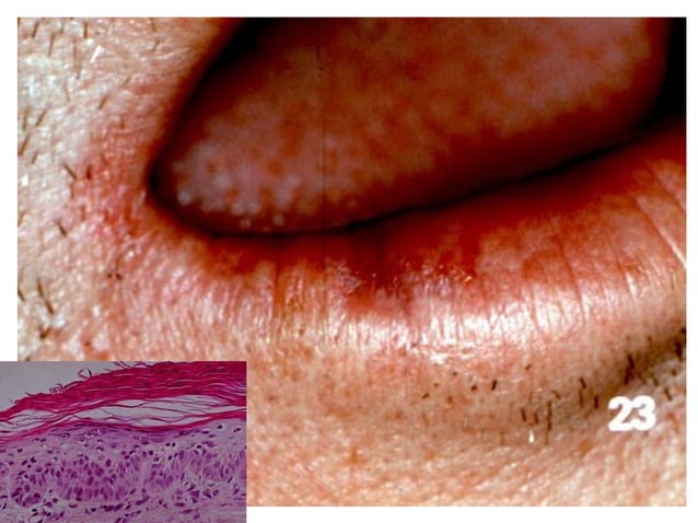 mucous membrane disorders for nurses 1.ppt