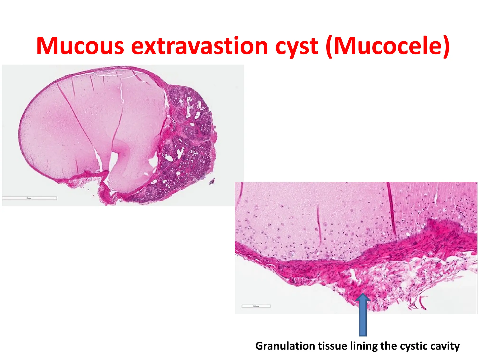 Mucous retention and mucous extravastion cysts.pdf