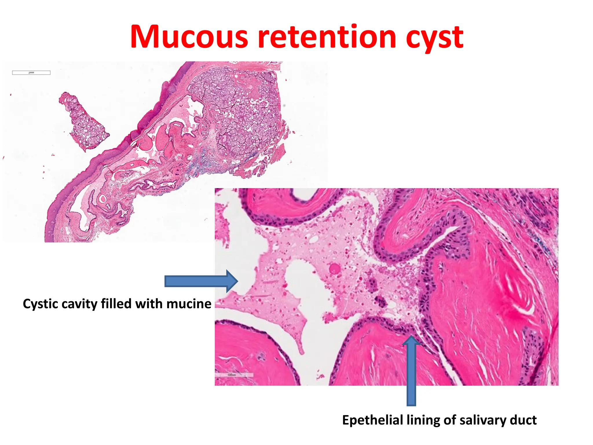 Mucous retention and mucous extravastion cysts.pdf