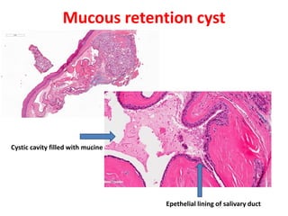 Mucous retention and mucous extravastion cysts.pdf