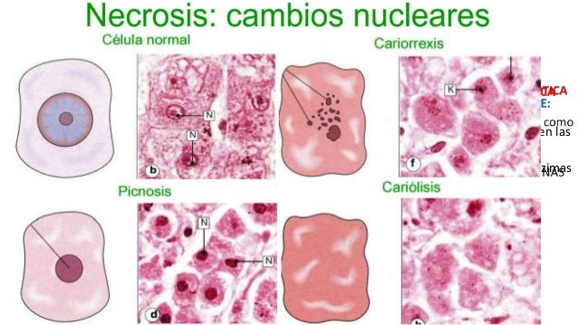 necrosis celular