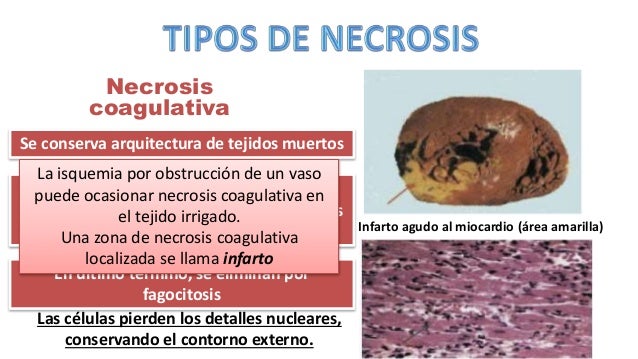 Patología-Muerte Celular