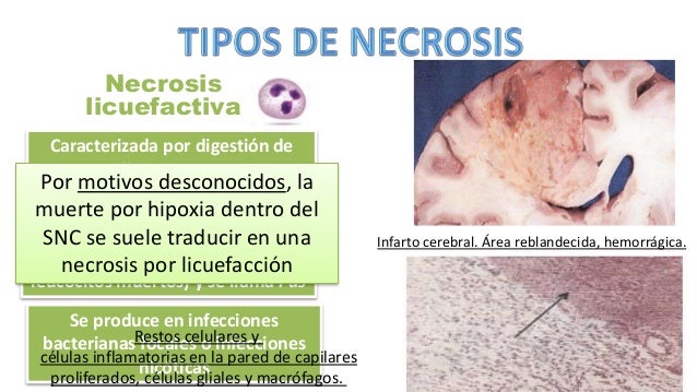 Patología-Muerte Celular