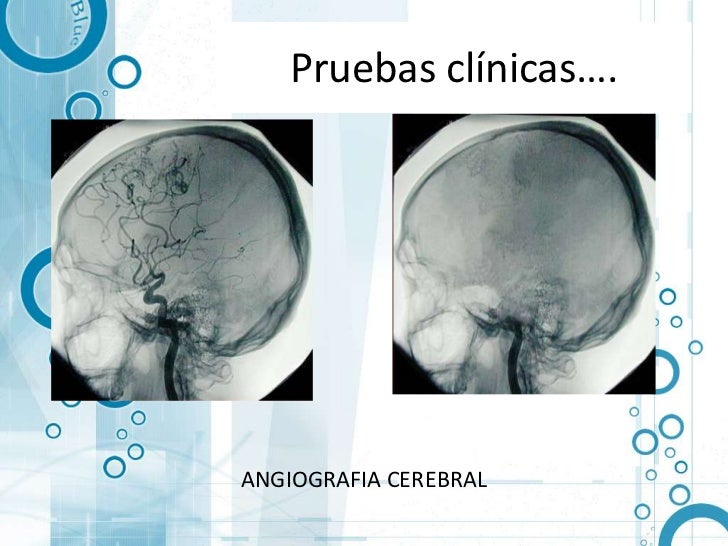 Muerte Cerebral Y Donacion De Organos