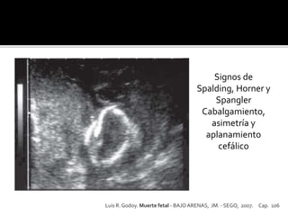 Muerte fetal | PPTX
