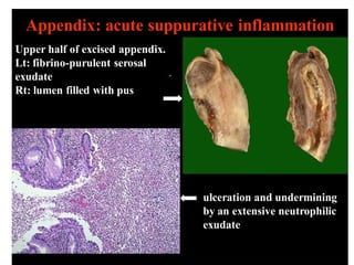 pattern of inflammation | PPT