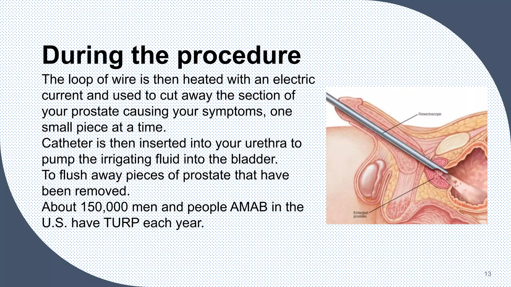 Transurethral Resection Of Prostrate Turp Pptx