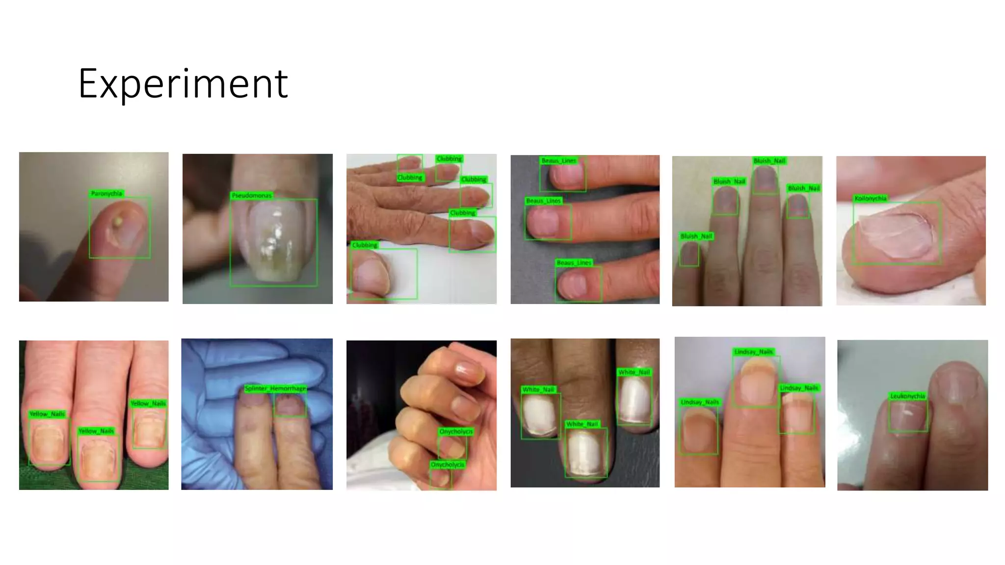FINGERNAIL DISORDER DETECTION FOR DISEASE ANALYSIS | PPTX