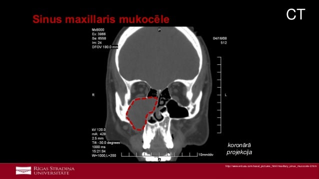 Deguna blakusdobumu mukocēle