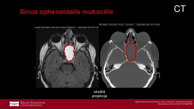 Deguna blakusdobumu mukocēle