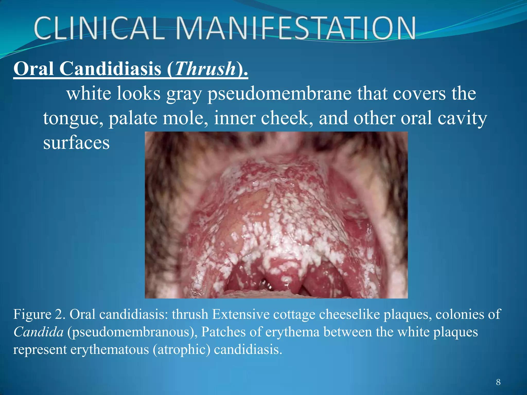 Mukokutan kandidiasis | PPTX