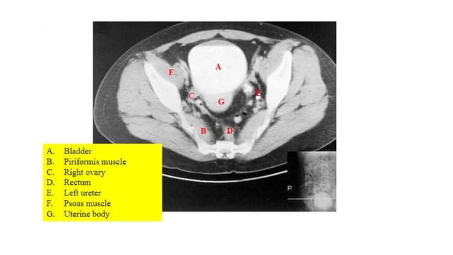 IMAGING & ITS ROLE IN FEMALE GENITAL CANCER | PPTX