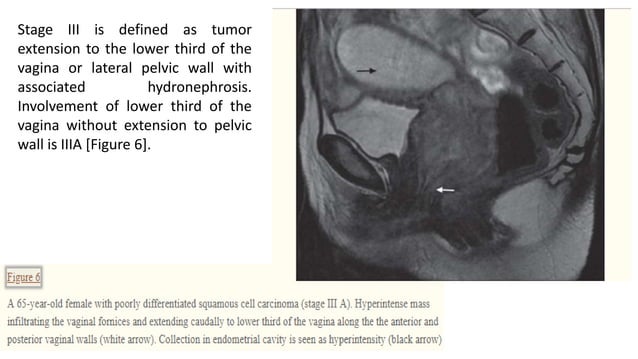 IMAGING & ITS ROLE IN FEMALE GENITAL CANCER | PPTX