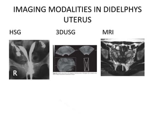 Mullerian anomalies | PPT