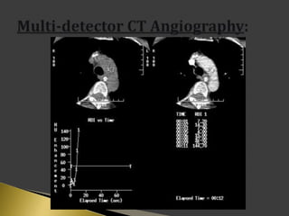 Multi detector ct cerebral angiography | PPTX