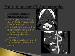 Multi detector ct cerebral angiography | PPTX