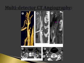 Multi detector ct cerebral angiography | PPTX