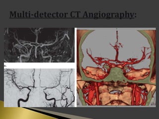 Multi detector ct cerebral angiography | PPT