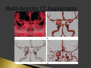 Multi detector ct cerebral angiography | PPT