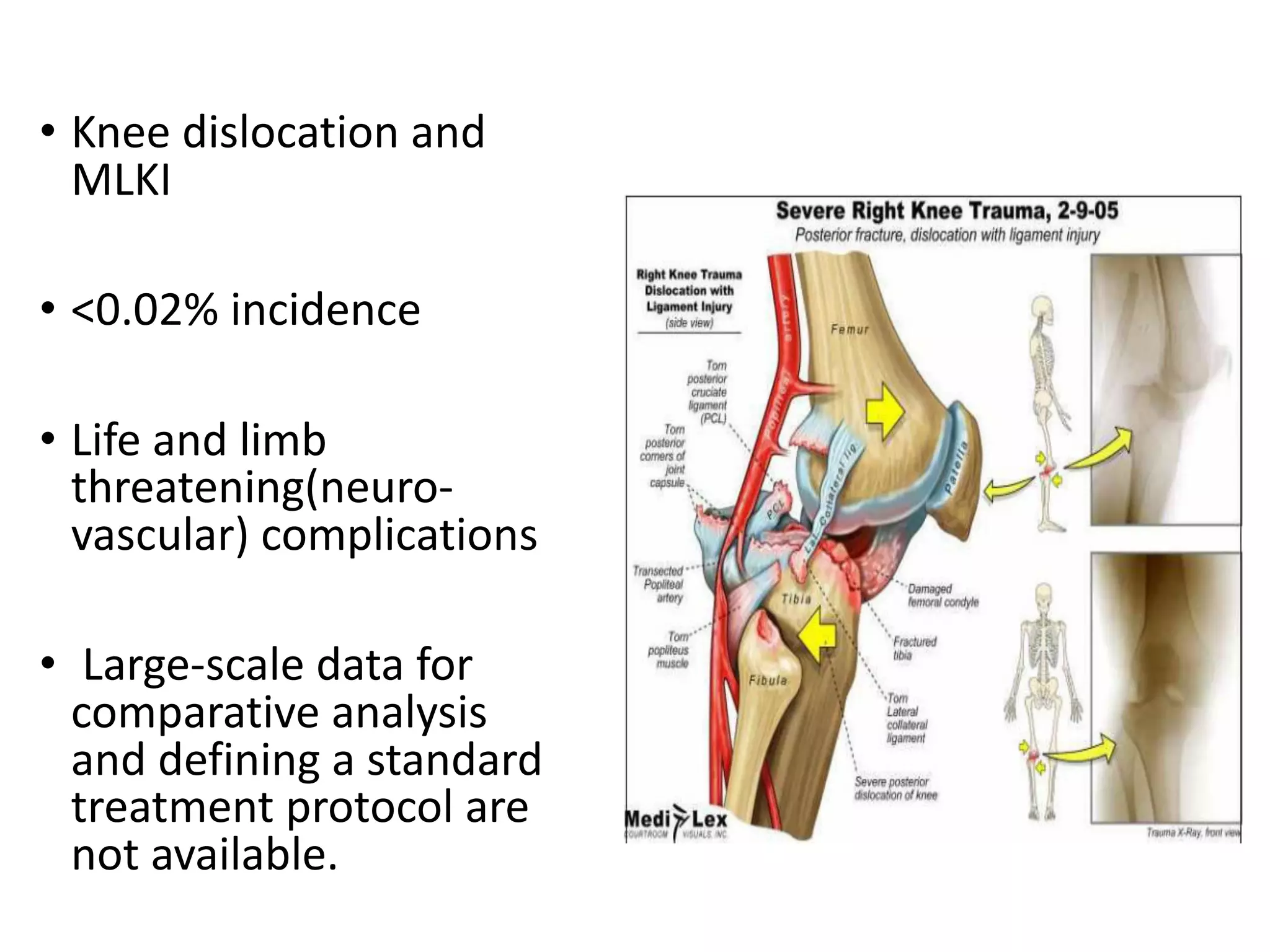 Multi ligamentous knee injury | PDF