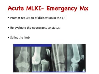 Multi ligamentous knee injury | PDF