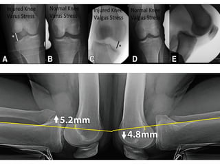Multi ligamentous knee injury | PDF