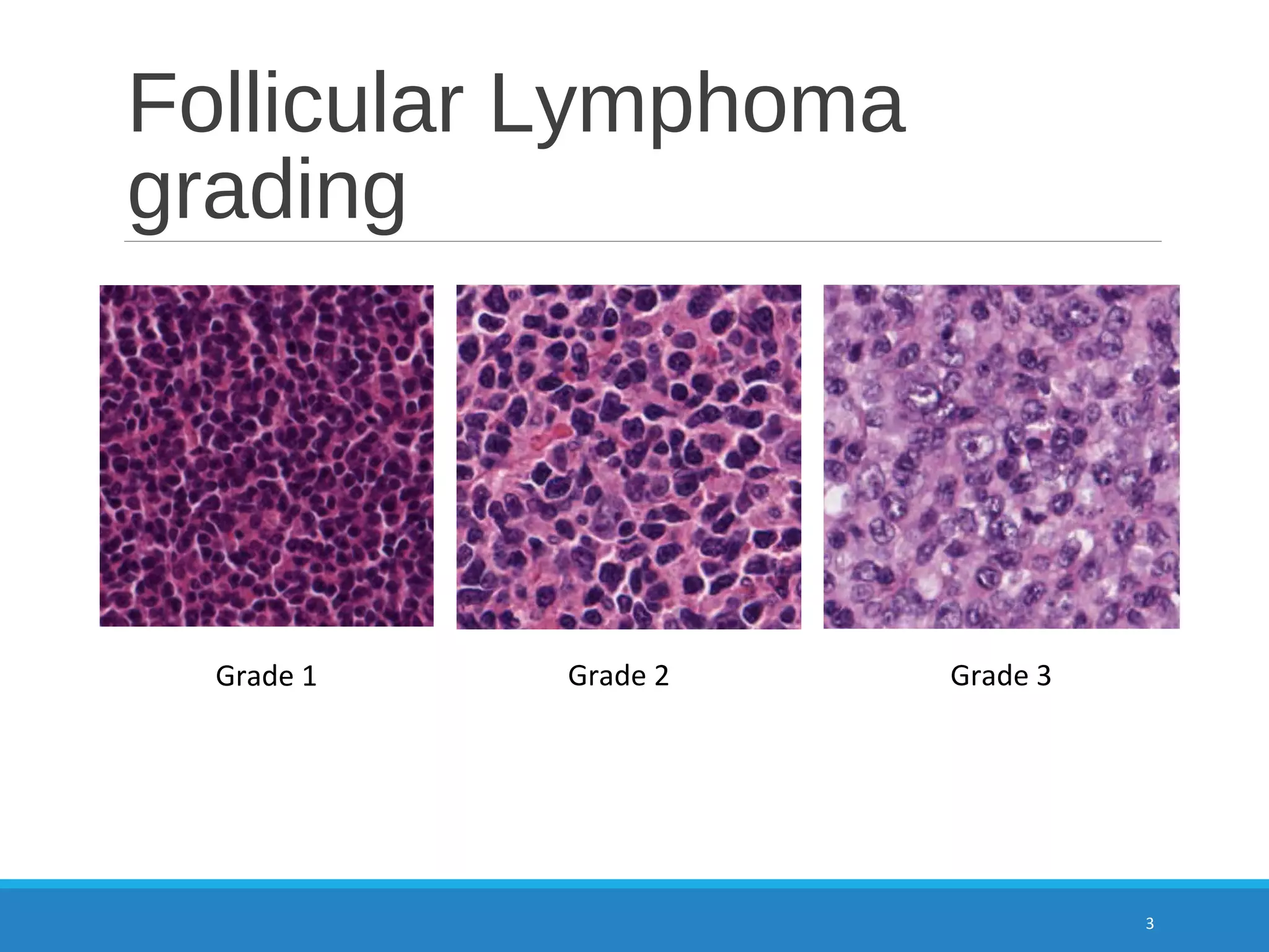Multi Scale Directional Filtering Based Method for Follicular Lymphoma ...