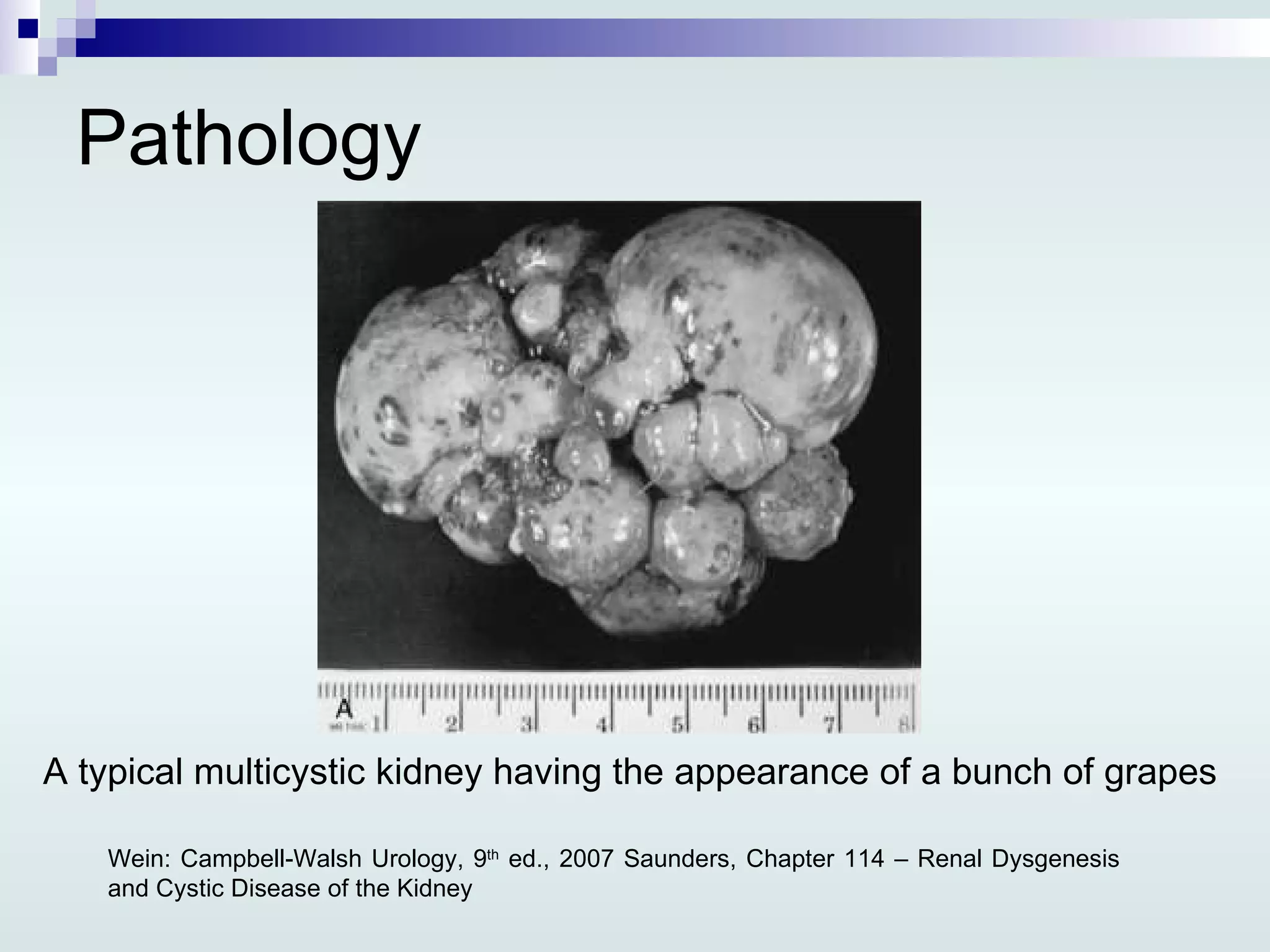 Multicystic Dysplastic Kidney | PPT