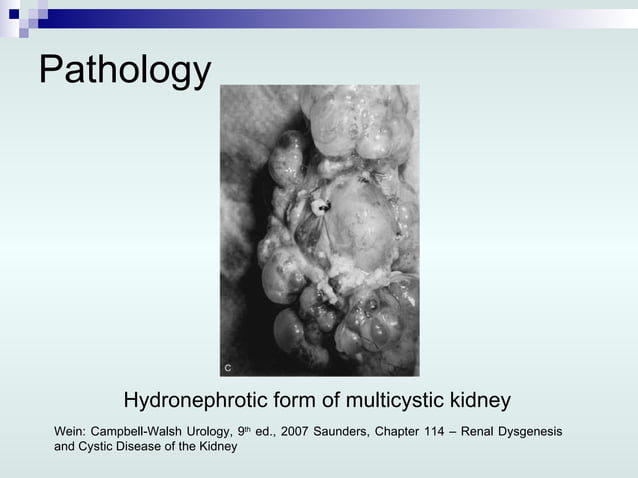 Multicystic Dysplastic Kidney | PPT