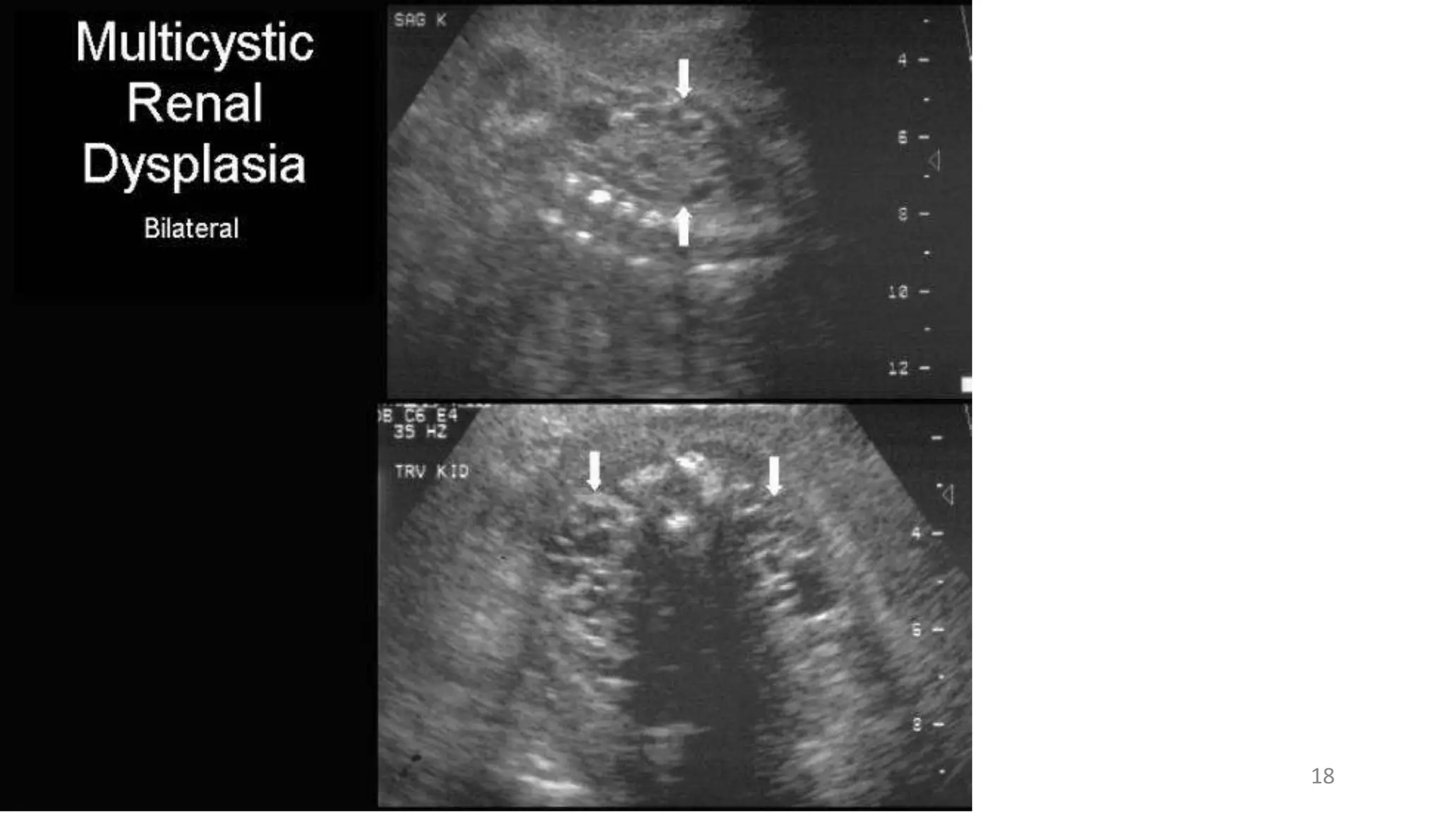 Multicystic Dysplastic Kidney.pptx