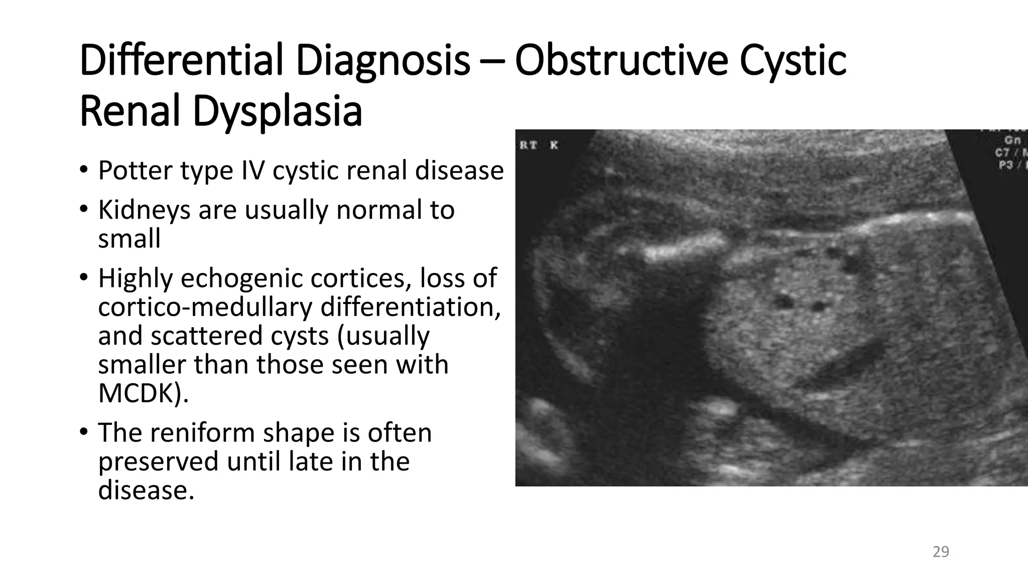 Multicystic Dysplastic Kidney.pptx