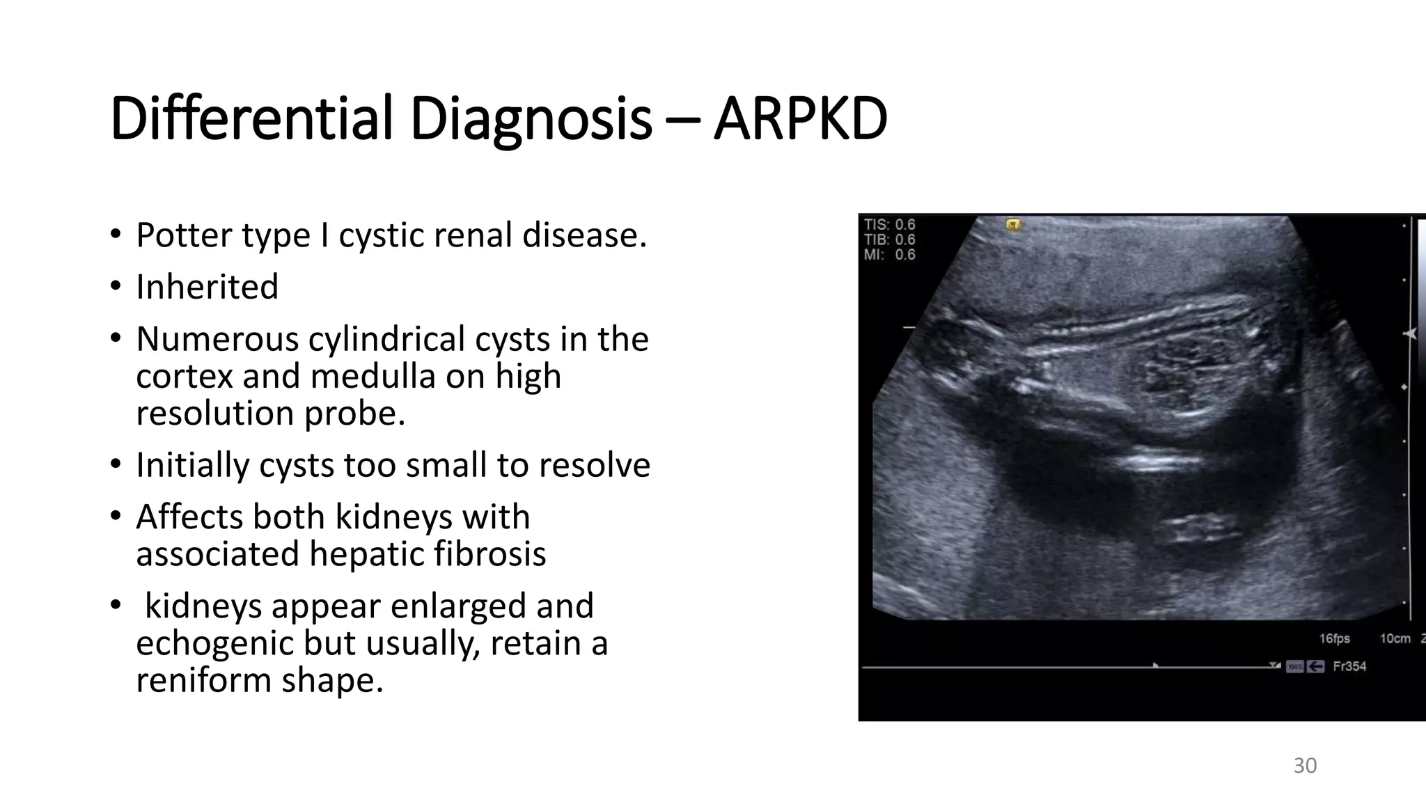 Multicystic Dysplastic Kidney.pptx