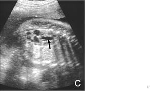 Multicystic Dysplastic Kidney.pptx