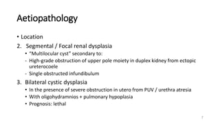 Multicystic Dysplastic Kidney.pptx