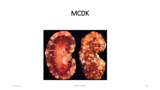 Multi cystic dysplastic kidney (renal dysplasia) | PPTX