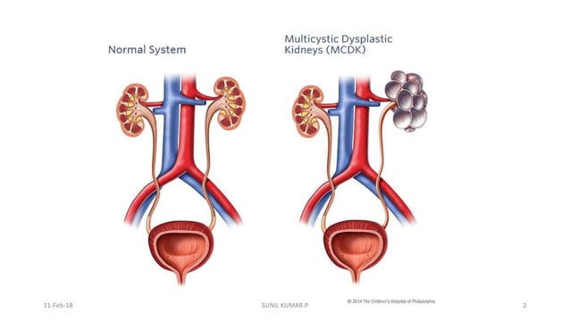 Multi cystic dysplastic kidney (renal dysplasia)