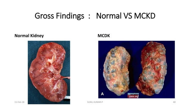 Multi cystic dysplastic kidney (renal dysplasia)