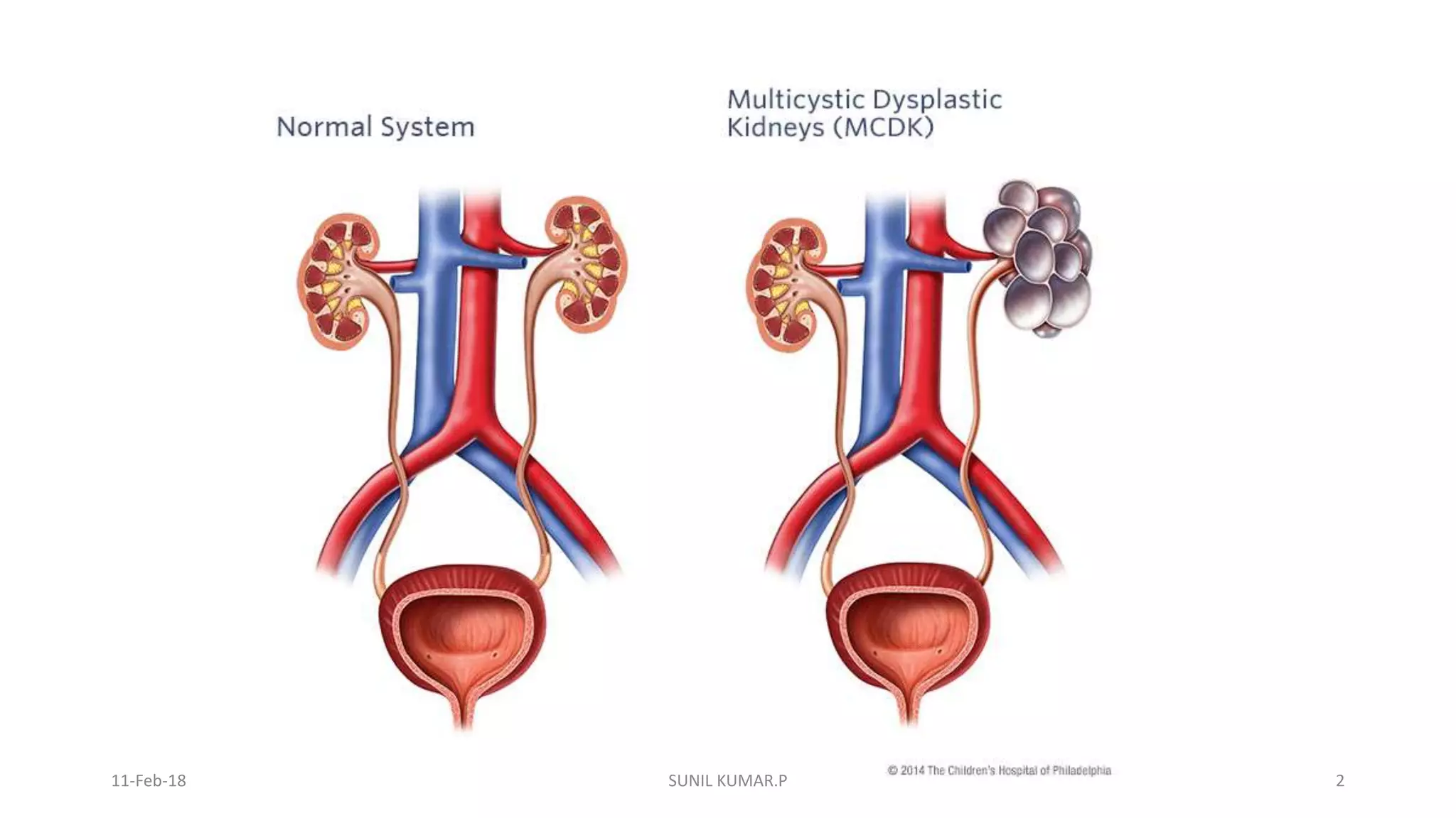 Multi cystic dysplastic kidney (renal dysplasia) | PPTX