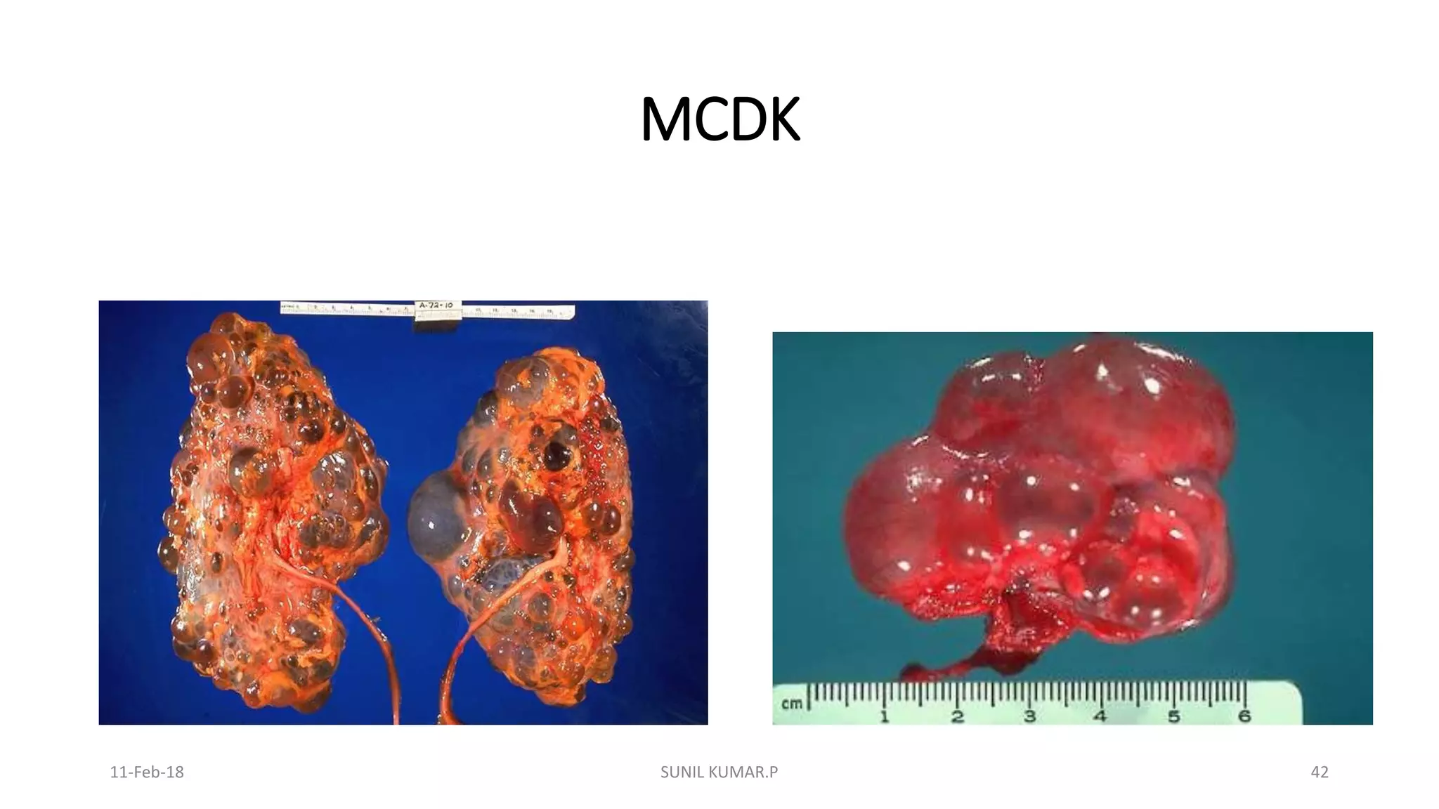 Multi cystic dysplastic kidney (renal dysplasia) | PPT