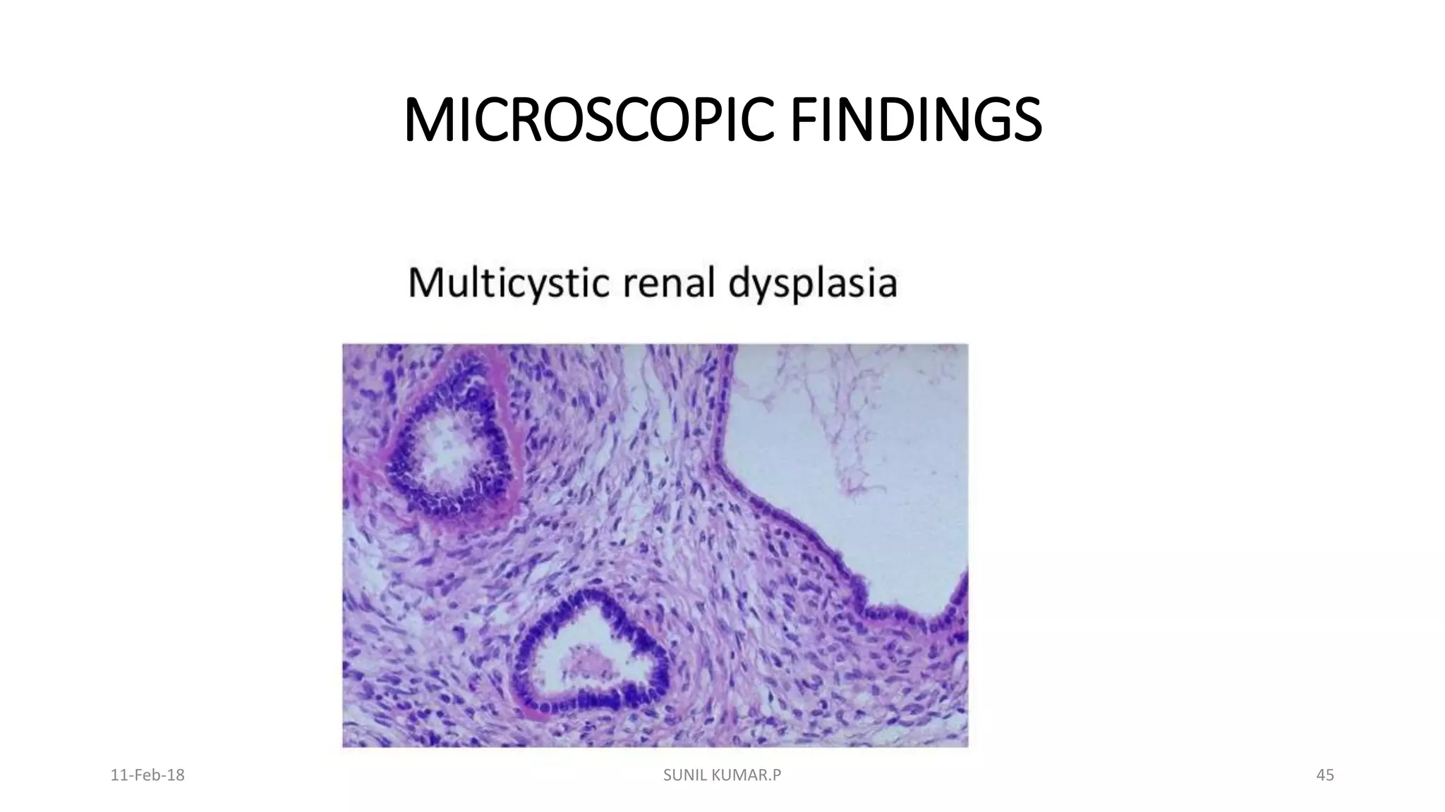 Multi cystic dysplastic kidney (renal dysplasia) | PPT