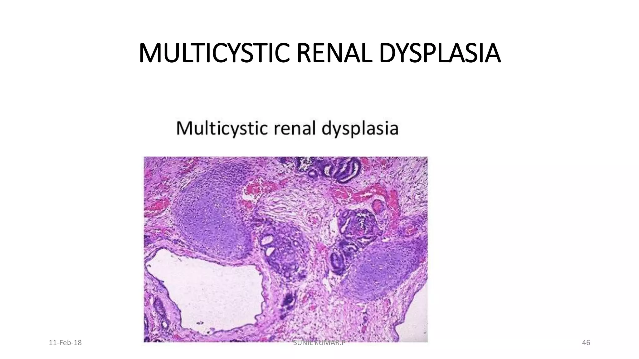 Multi cystic dysplastic kidney (renal dysplasia) | PPTX
