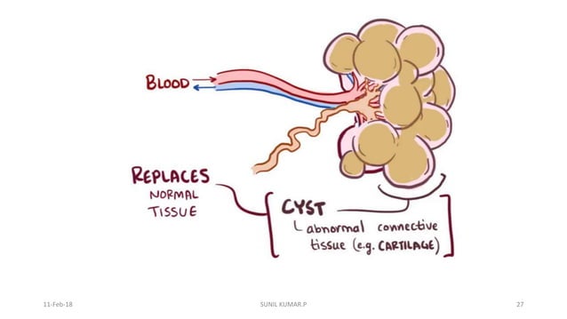 Multi cystic dysplastic kidney (renal dysplasia) | PPT