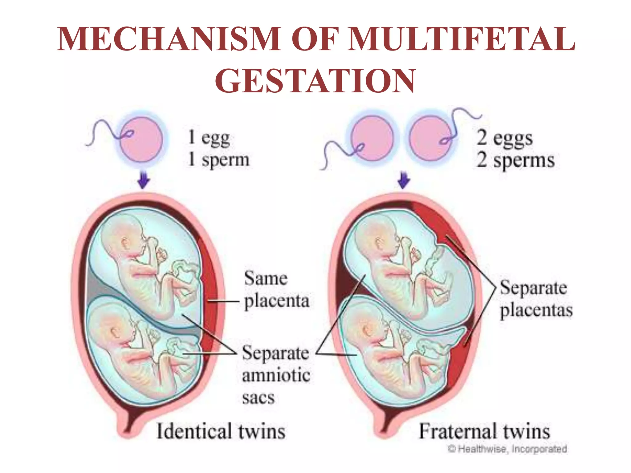 Multifetal gestation | PPTX