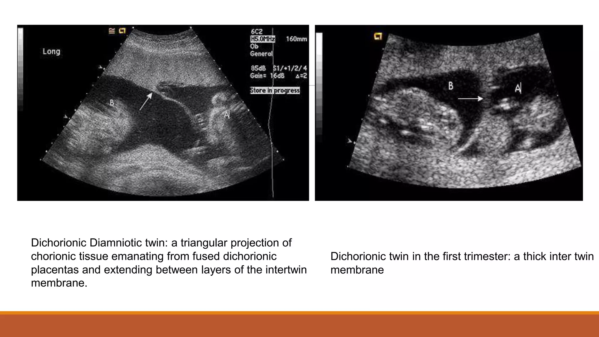 Multifetal pregnancy (Twins Pregnancy) | PPTX