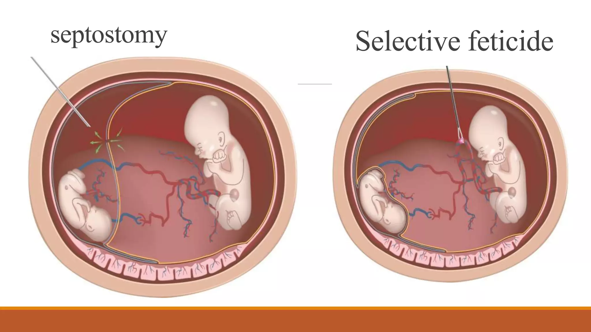Multifetal pregnancy (Twins Pregnancy) | PPTX