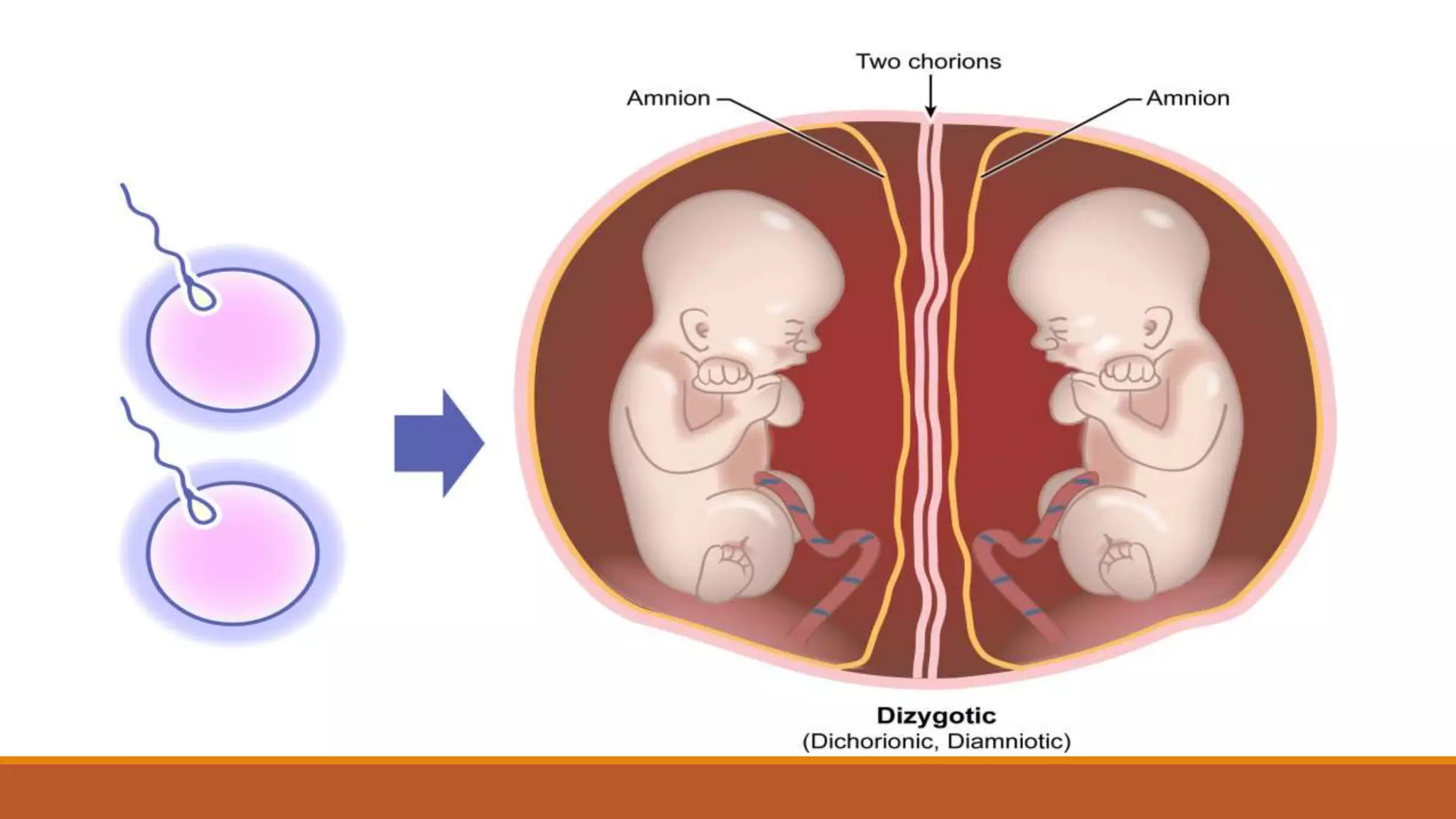 Multifetal pregnancy (Twins Pregnancy) | PPTX